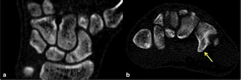 Concomitant Hook Of Hamate Fractures In Patients With Scaphoid Fracture
