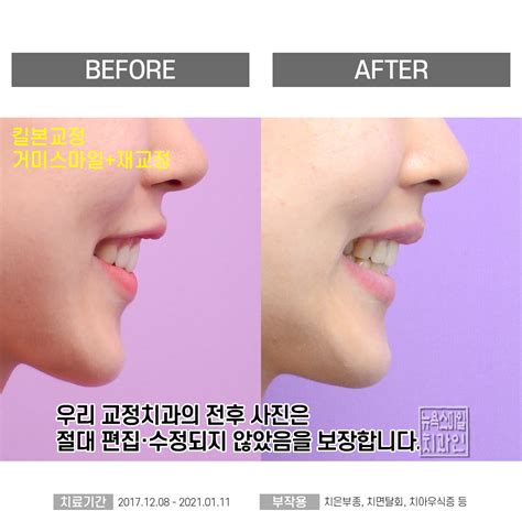 킬본교정 거미스마일 재교정 Before And After 미국 교정 전문의 부산 뉴욕스마일 치과