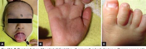 Ectodermal Dysplasia Hands