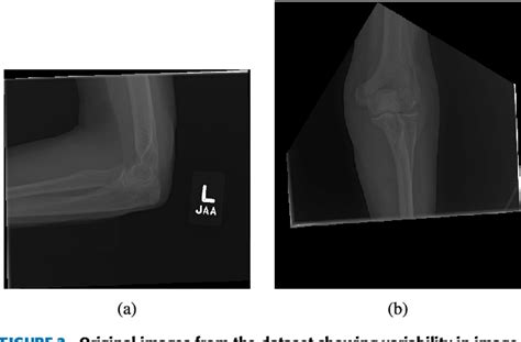 Figure 2 From Abnormality Detection In Musculoskeletal Radiographs