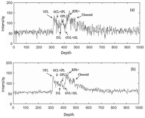 Optical Coherence Tomography Denoising Method Based On Bilateral Random Projection Eureka