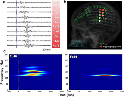 High Frequency Oscillatory Treatment At Lori Birdwell Blog