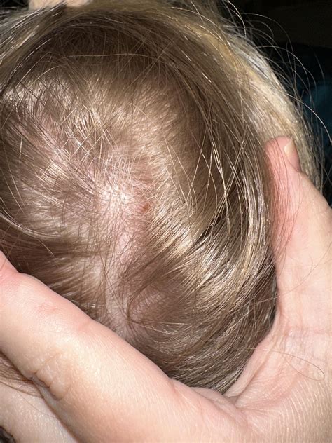 Scabs On Scalp R Dermatologyquestions