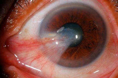 Pterygium Wikipedia