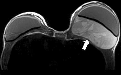 Mri For Evaluation Of Complications Of Breast Augmentationradiographics