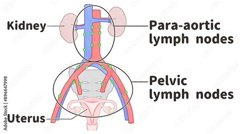 The Pelvic And Para Aortic Lymph Nodes Labeled Diagram Png Stock