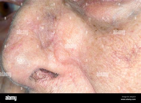 Close Up Of The Scar On The Nose In An 82 Year Old Female Patient After