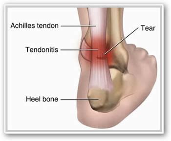 Difference Between Tendonitis Tendinosis And Tendinopathy Tendonitis Vs Tendinosis Vs