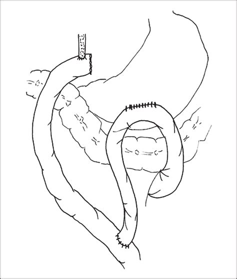 —combined Gastric And Biliary Bypass For The Treatment Of Obstructive Download Scientific —combined Gastric And Biliary Bypass For The Treatment Of Obstructive Download Scientific