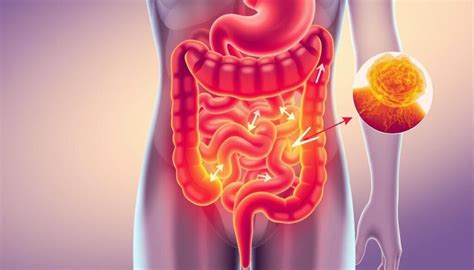 Understanding Inflammatory Bowel Disease Ibd