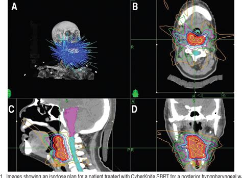 Figure 1 From Emerging Applications Of Stereotactic Radiotherapy In