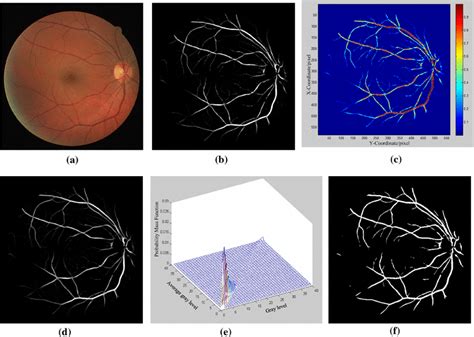 Steps In The Proposed Vessel Segmentation Procedure A A Sample Fundus