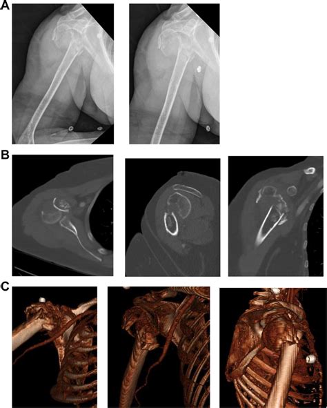 Comminuted Proximal Humerus Fracture As Assessed First With A Plain Download Scientific
