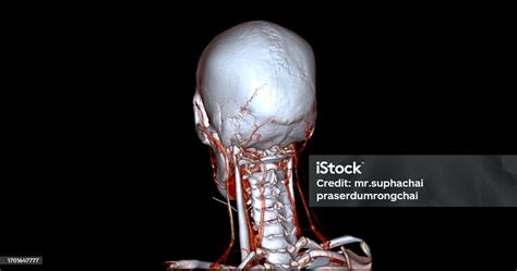 뇌의 Ct 혈관 조영술 또는 Cta 뇌와 목 시상 보기 3d 렌더링 이미지 융합 색상 모드 의료 기술 개념입니다 0명에 대한 스톡 사진 및 기타 이미지 Istock