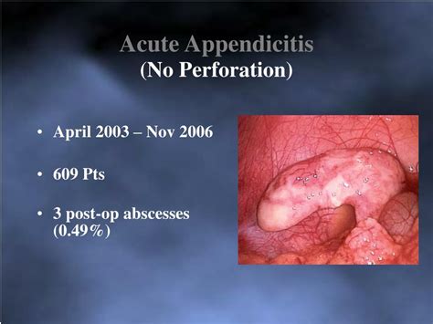 Ppt Appendicitis Current Management Powerpoint Presentation Free