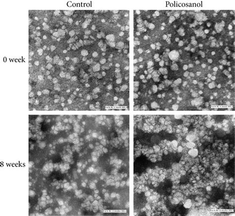 Electron Microscopic Observation Of Hdl2 A Illustrative Image Of
