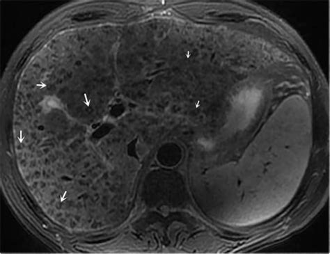 Cholangitis Gastrointestinal Pathology Pathology Achievable Usmle 1