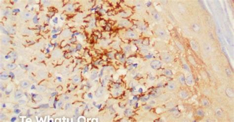 Syphilis Pathology With Organisms Shown By Treponema Pallidum
