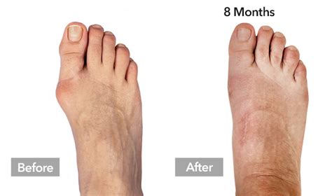 Lapiplasty® Mini Incision™ Procedure Treace Medical Concepts Inc