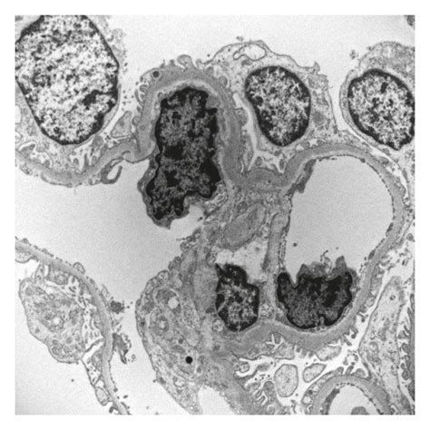 Renal Biopsy Findings A One Glomerulus Showing Segmental