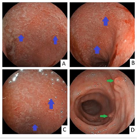 Endoscopic View Of Mayo 3 Proctosigmoiditis With Significant Mucosal