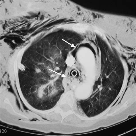 A Management Algorithm For Post Intubation Tracheal Rupture Modified Download Scientific