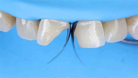 Unica Proximal Anterior Matrices Polydentia