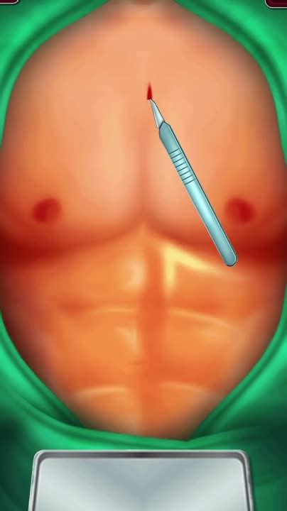 Dr S Atheena Milagi Pandian On Linkedin Abdominal Surgery Is Called A