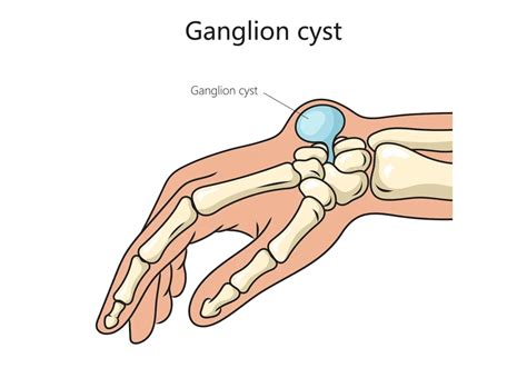 Ganglion Cyst Retinacular Cyst Hand And Nerve Surgeon