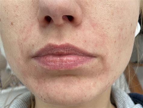 Perioral Dermatitis
