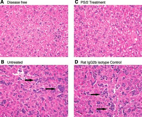 Ps 2 Treatment Reduced Myeloma Tumor Burden In The Liver Hande Stained Download Scientific
