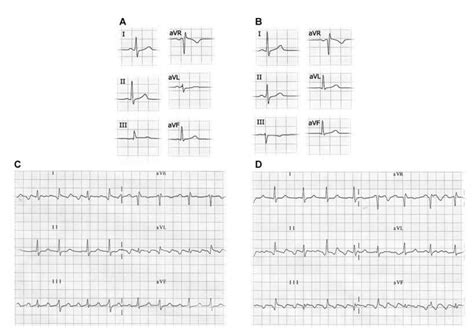 A Electrocardiogram Recorded With Left Leg—left Arm