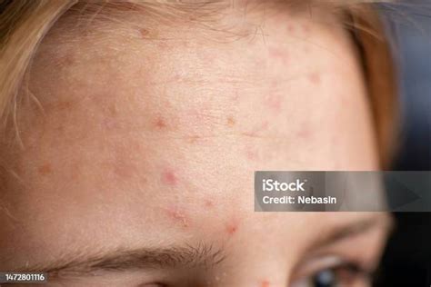 십 대 소녀의 이마에 여드름 염증이있는 피부 클로즈업 청소년기 청소년기 클로즈업 이마 표면 전체에 작은 여드름 사람 얼굴에 대한 스톡 사진 및 기타 이미지 Istock