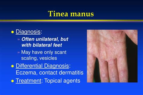Ppt Fungal Infections Of The Skin And Nails Powerpoint Presentation