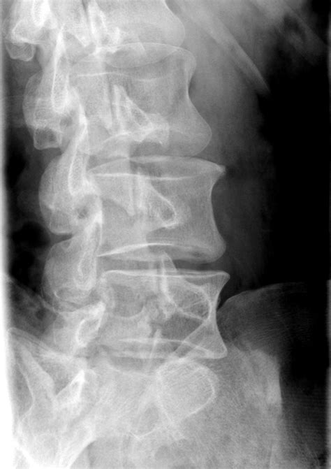 The Thoracolumbar Spine