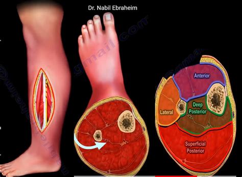 Left Leg Fasciotomy