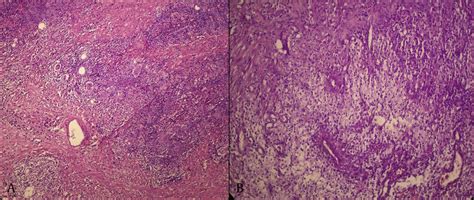 Types Of Granulomatous Prostatitis A Post Turp Granulomatous Download Scientific Diagram