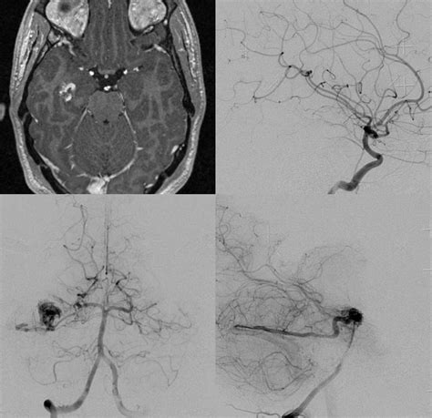 Posterior Cerebral Artery Neuroangio Org