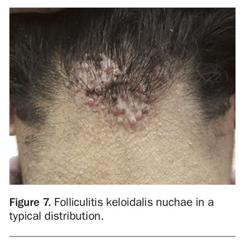 Bacterial Folliculitis Scalp