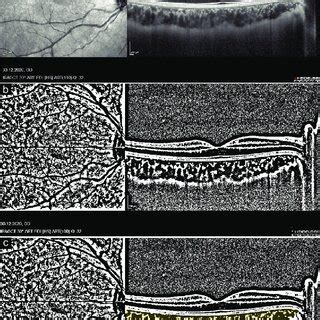 A Enhanced Depth Optical Coherence Tomography Image B The Image Download Scientific