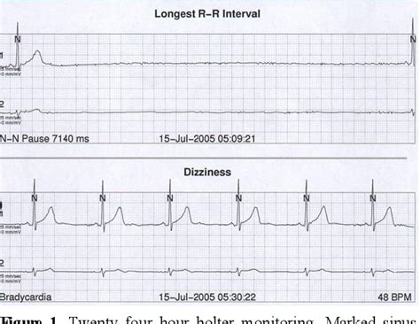Figure 1 From A Case Of Carotid Sinus Syncope Due To Maxillary Neoplasm