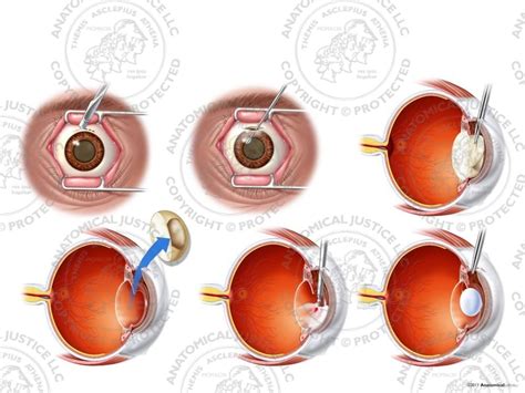 Cataract Extraction With Intraocular Lens Icd 10 At Louise Rizo Blog