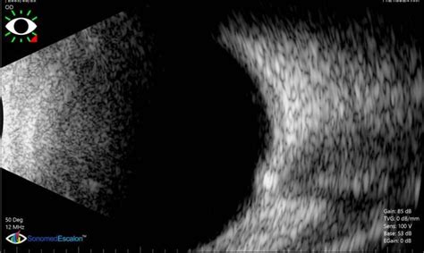 Oct Article Case Study Advanced Oct Diagnostics For Buried Optic
