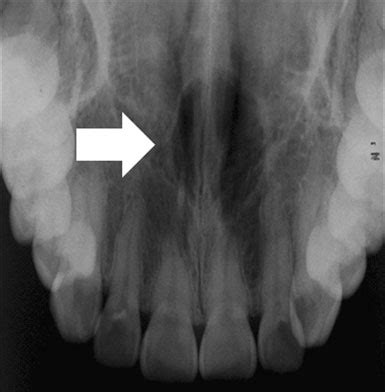 Xray Windows Xray Technique And Xray Analysis Radiolucent