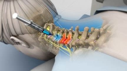 Cervical Medial Branch Block The Pain Pump Institute