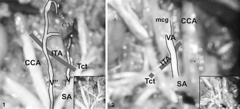 Segments Of The Vertebral Artery Insight In The Developmental Changes Up To The St Year Of