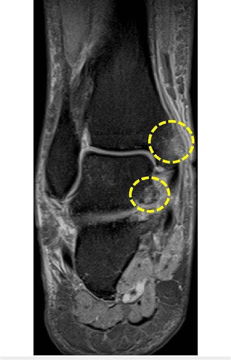 Contusional Edema Of The Medial Malleolus And The Medial Process Of The