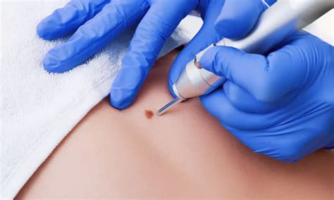 Skin Tag Removal For Miami Homestead Sarasota Venice Bradenton