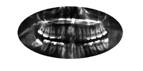 Dentalai I4clz Ss Dawl Object Detection Dataset By Roboflow20vl Semisupervised