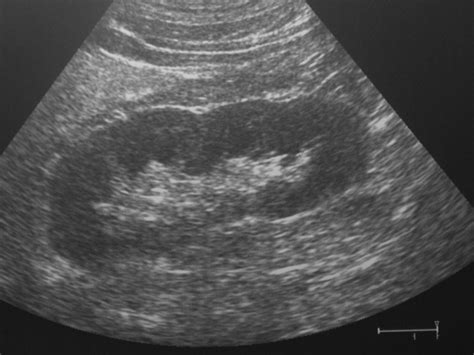 Renal Papillary Necrosis Ultrasound Pictorial Review Renal Ultrasound